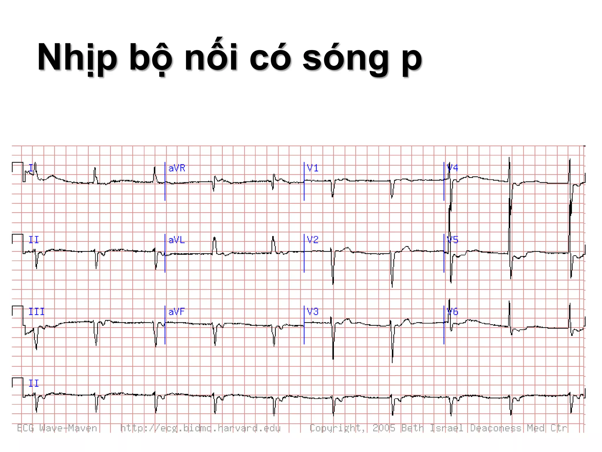 CÁC DẠNG NHỊP TRONG ECG | PDF