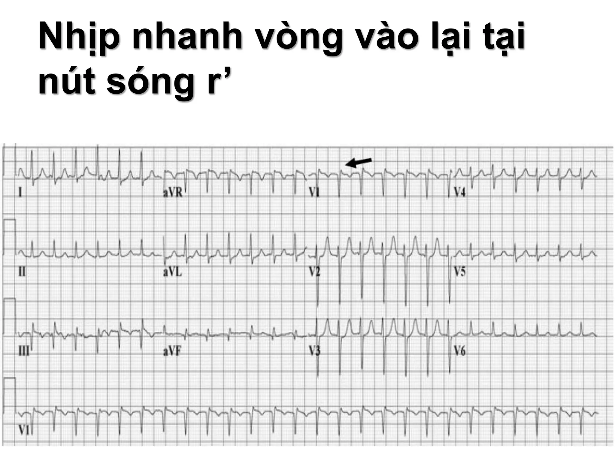 CÁC DẠNG NHỊP TRONG ECG | PDF