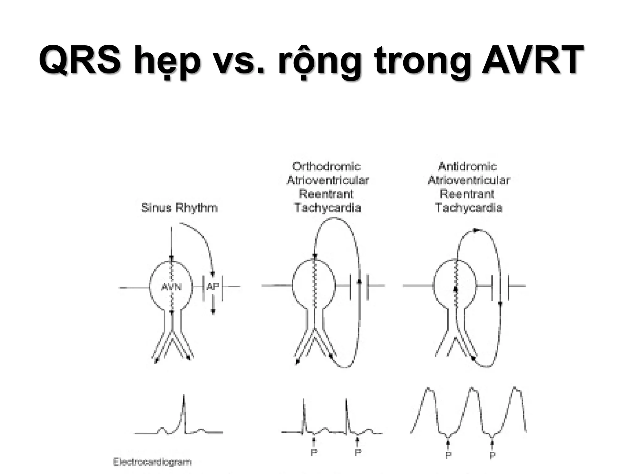 CÁC DẠNG NHỊP TRONG ECG | PDF