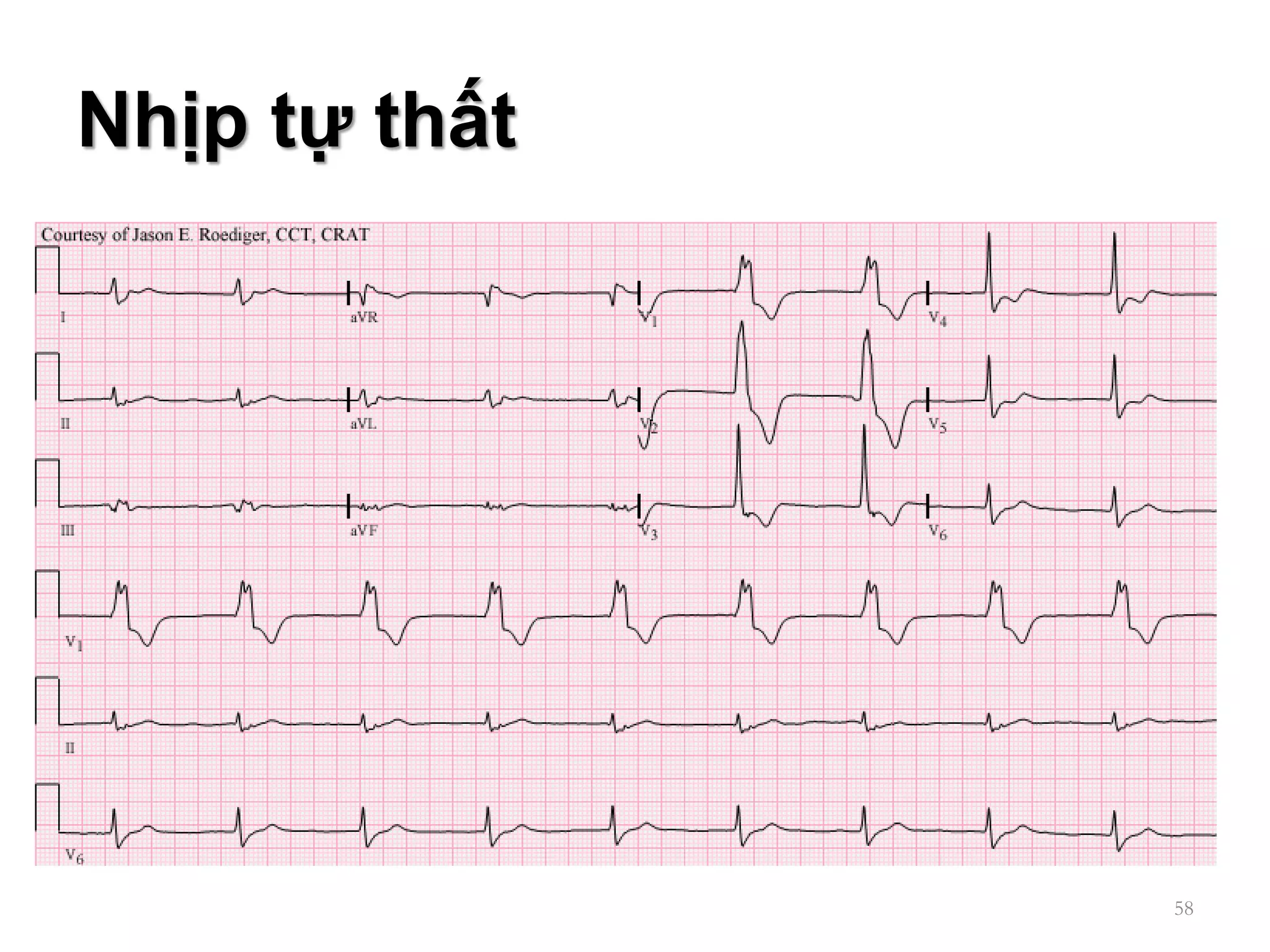CÁC DẠNG NHỊP TRONG ECG | PDF
