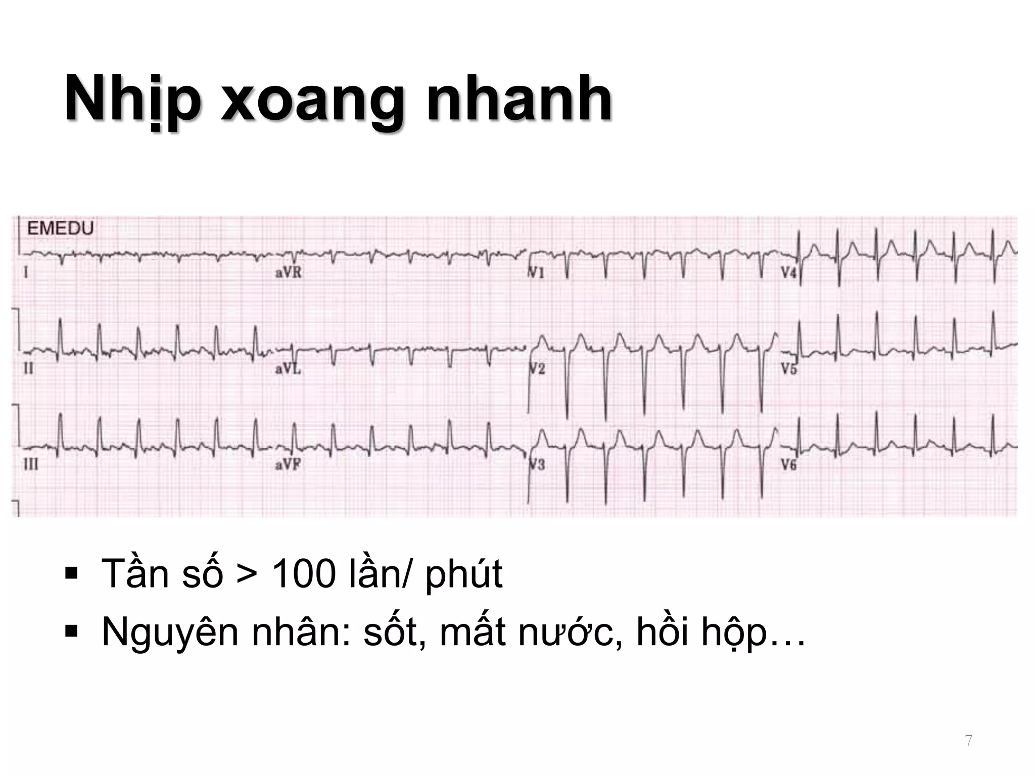 CÁC DẠNG NHỊP TRONG ECG | PDF