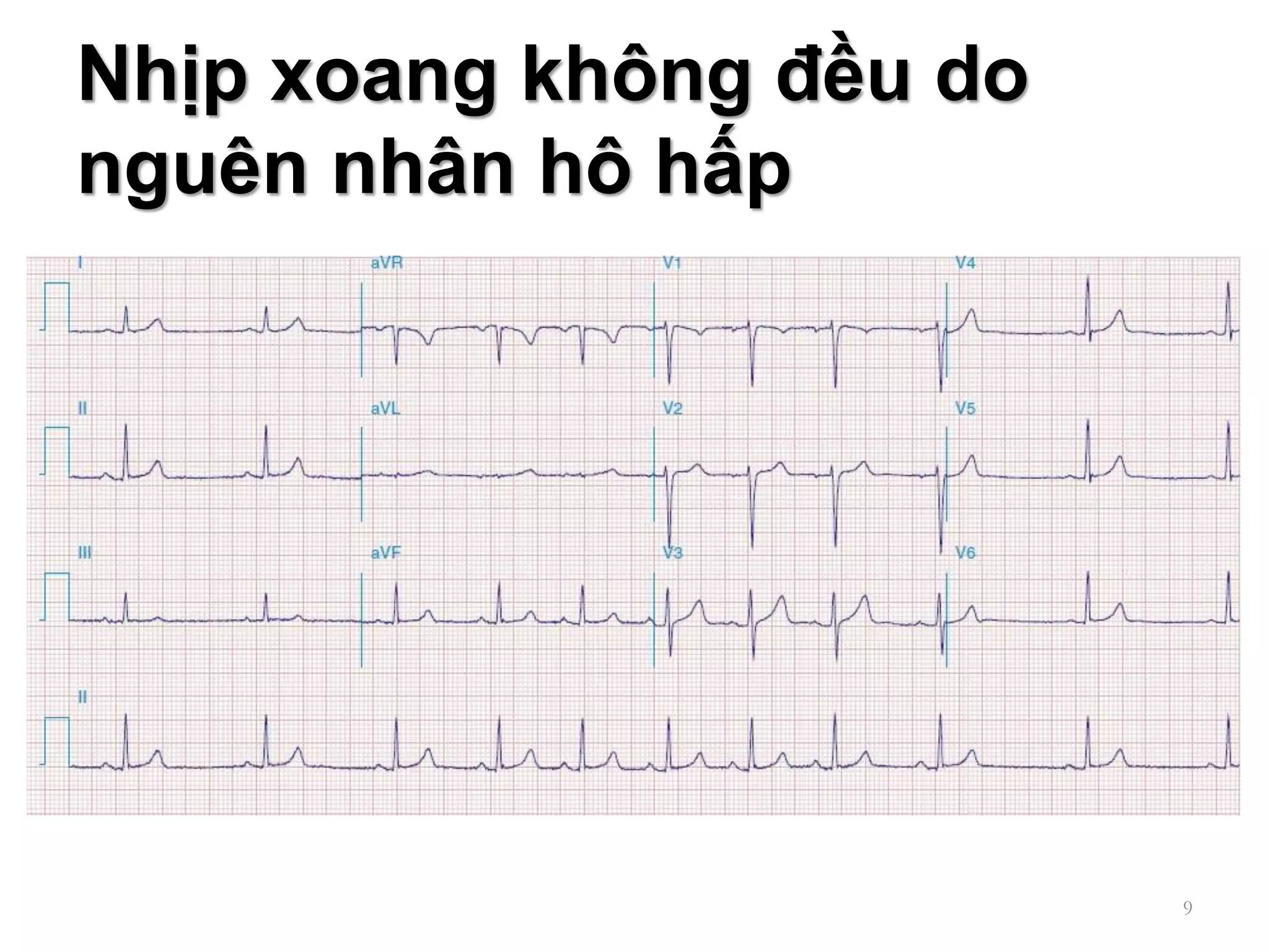 CÁC DẠNG NHỊP TRONG ECG | PDF