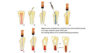 Curcumin—A Natural Medicament for Root Canal Disinfection: Effects of ...