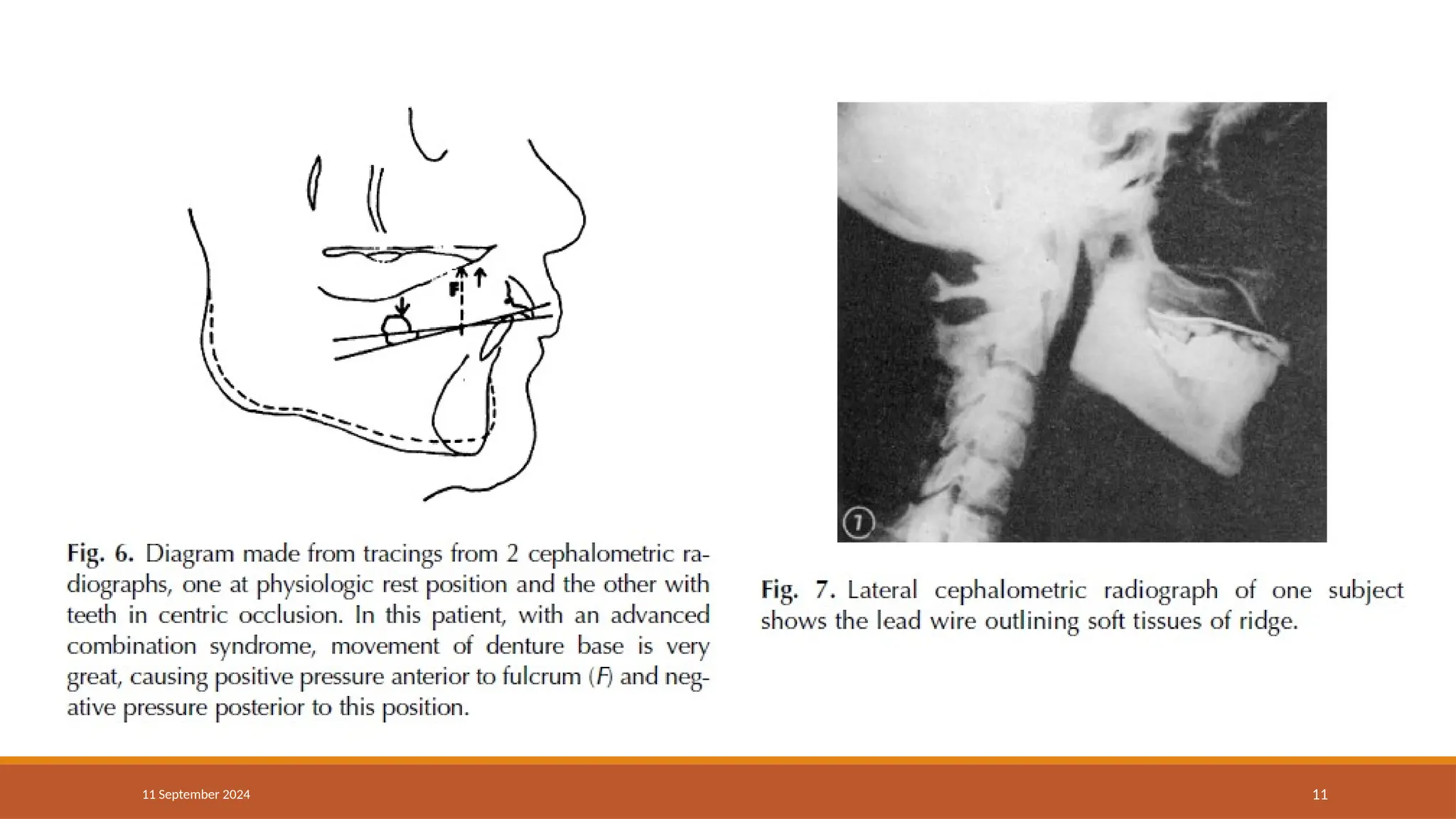 Kelly's combination syndrome and its management | PPTX