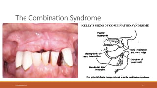 Kelly's combination syndrome and its management | PPTX