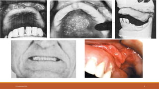 Kelly's combination syndrome and its management | PPTX