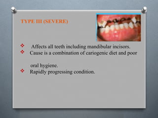 prevalance of early childhood caries and asssociation with feeding ...