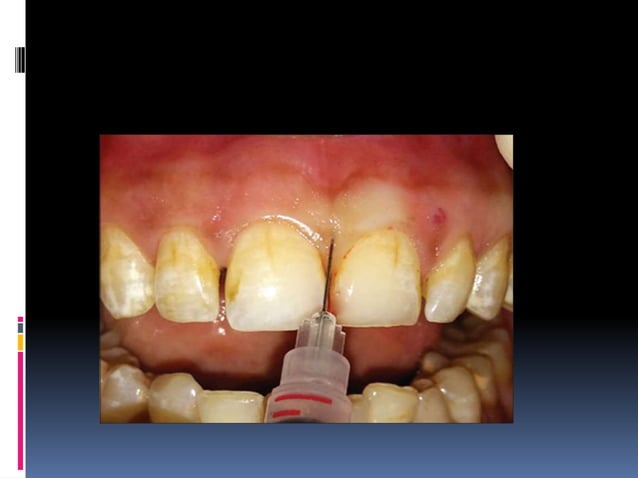 To evaluate the clinical efficacy of enhancing deficient interdental ...