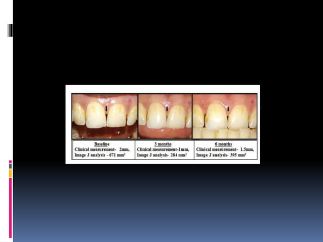To evaluate the clinical efficacy of enhancing deficient interdental ...