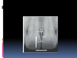 To evaluate the clinical efficacy of enhancing deficient interdental ...