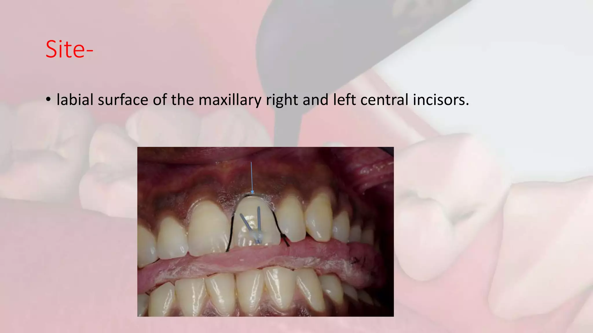 gingival retraction methods | PPTX