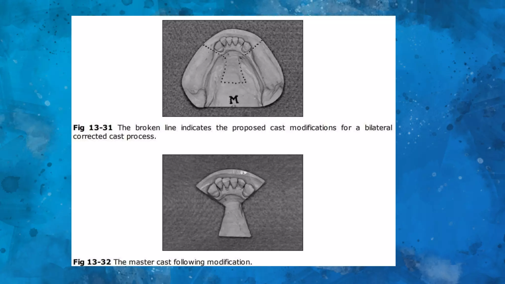 Prosthodontics Journal Club: Altered cast impression techniques | PPTX