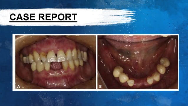 Prosthodontics Journal Club: Altered cast impression techniques | PPTX