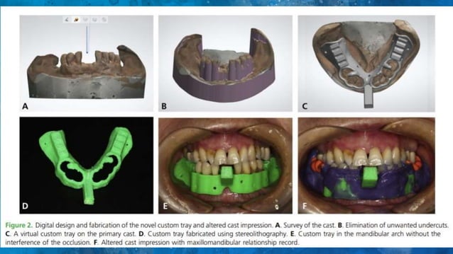 Prosthodontics Journal Club: Altered cast impression techniques | PPTX