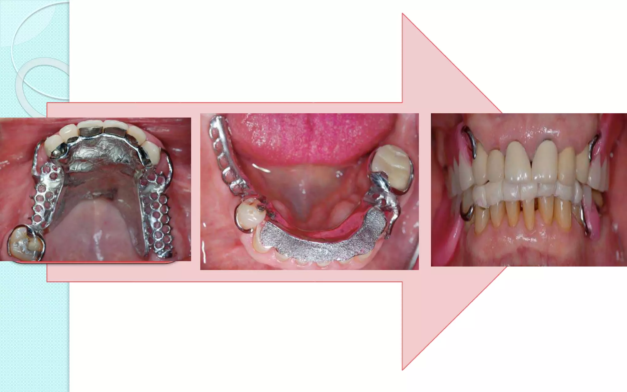 Journal Club Presentation on Overlay Removable Partial Denture | PPT