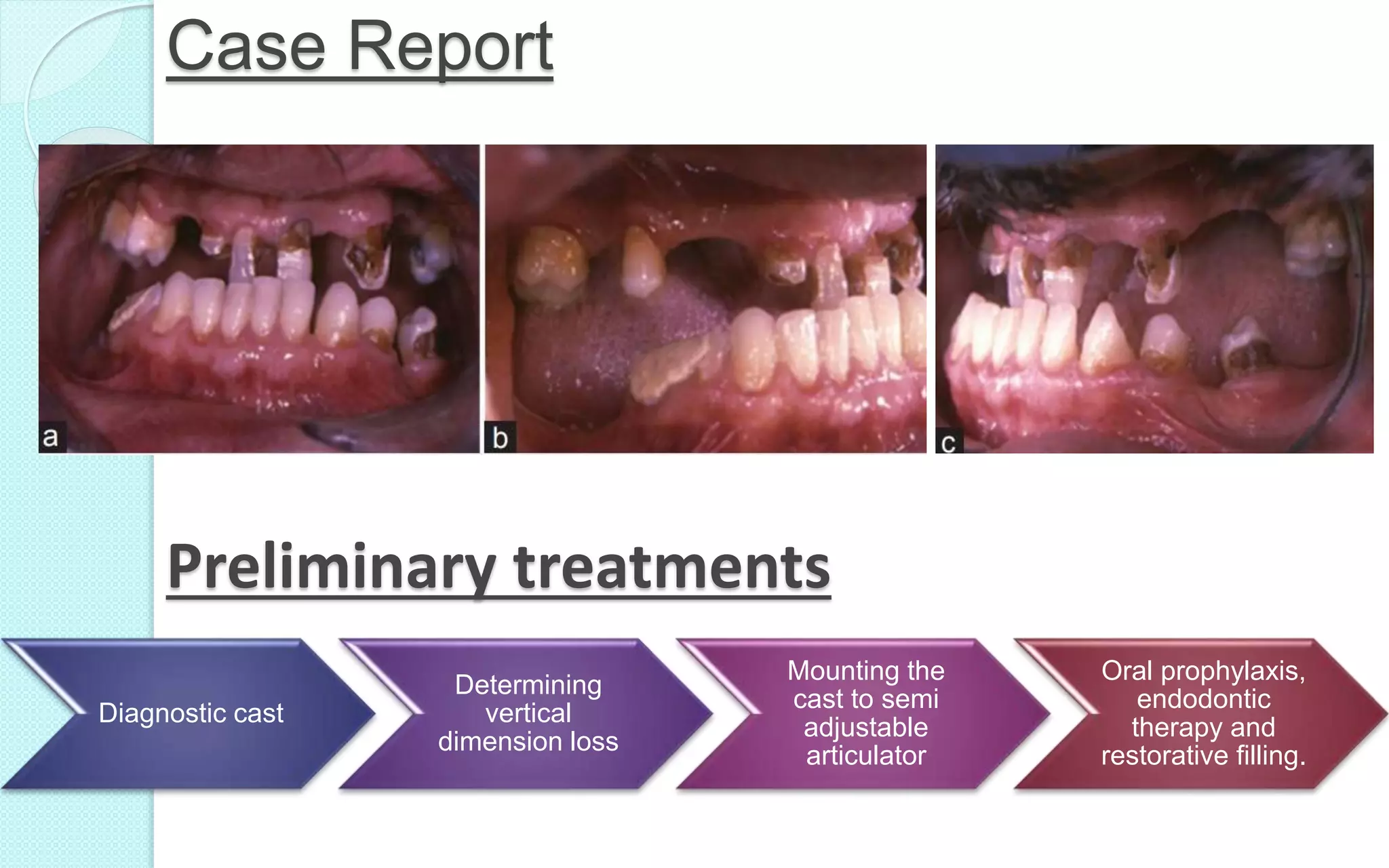 Journal Club Presentation on Overlay Removable Partial Denture | PPT
