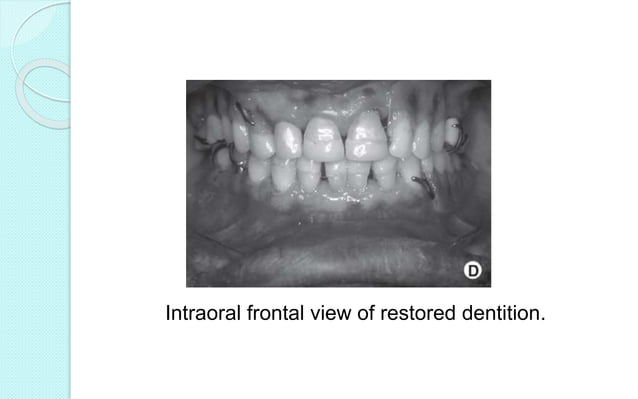 Journal Club Presentation on Overlay Removable Partial Denture | PPT