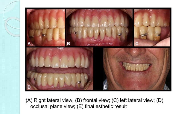 Journal Club Presentation on Overlay Removable Partial Denture | PPT