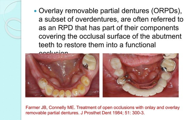 Journal Club Presentation on Overlay Removable Partial Denture | PPT