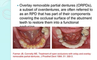 Journal Club Presentation on Overlay Removable Partial Denture | PPT