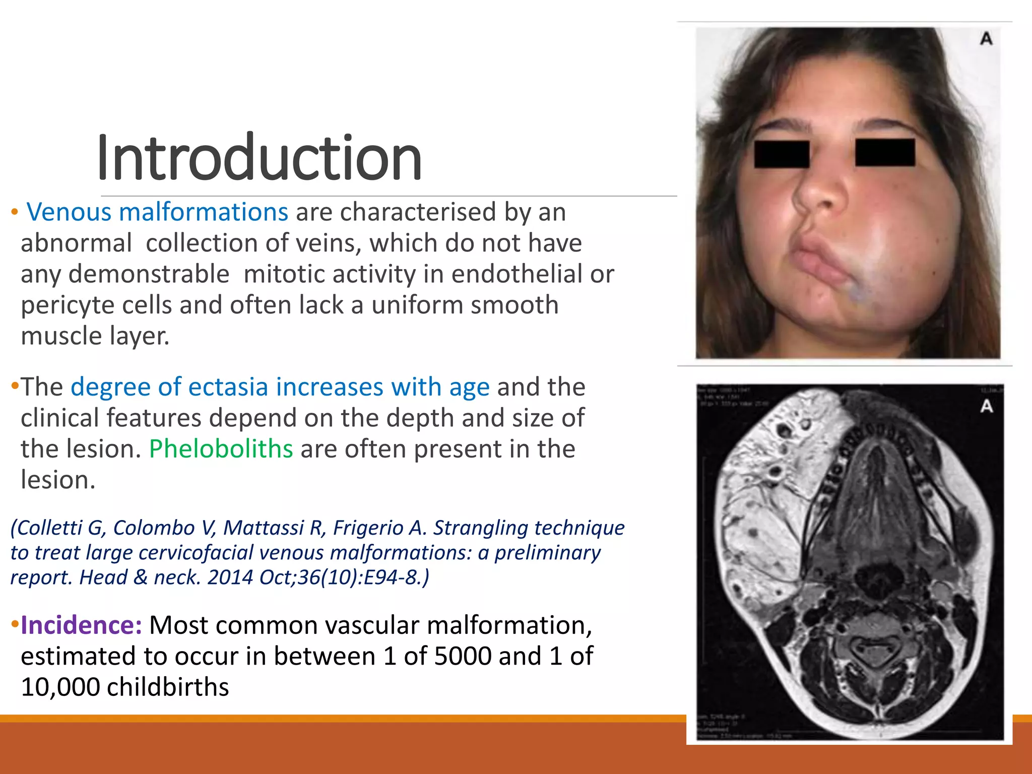 Corseting: A new technique for the management of diffuse venous ...