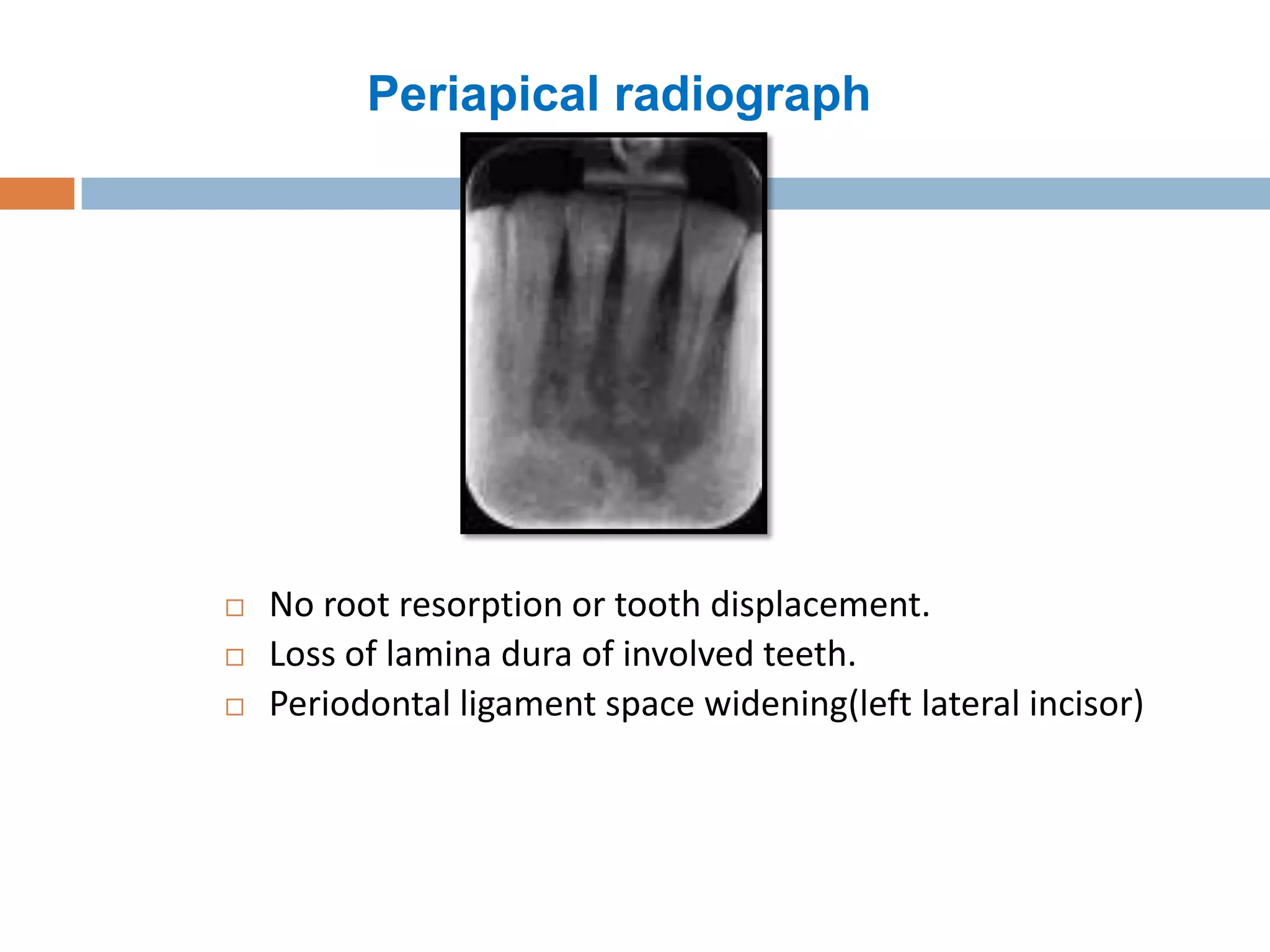 Jc 1 cbct findings of periapical cemento-osseous dysplasia | PPTX