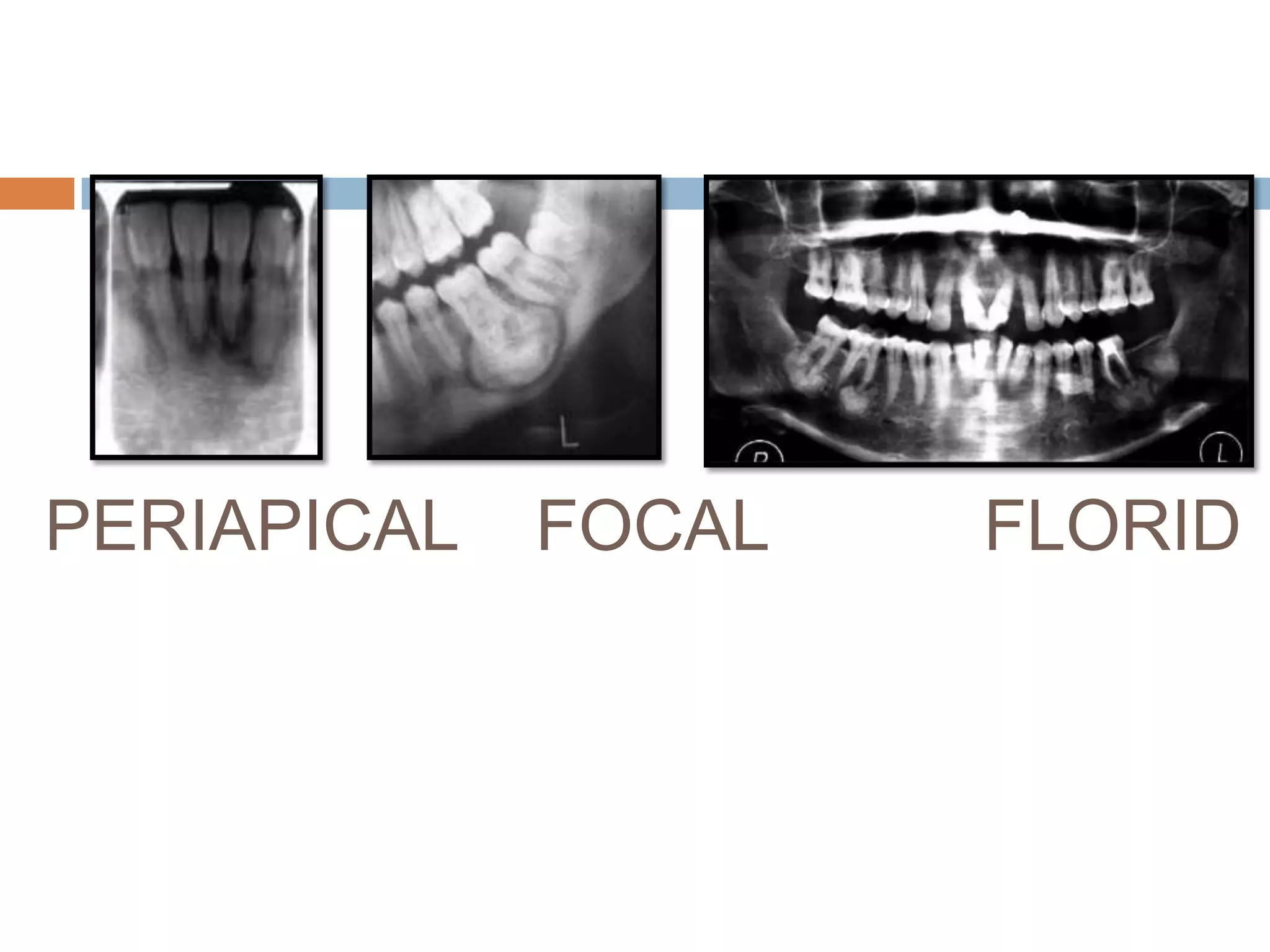 Jc 1 cbct findings of periapical cemento-osseous dysplasia | PPTX