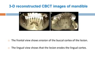Jc 1 cbct findings of periapical cemento-osseous dysplasia | PPTX