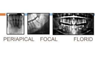 Periapical Cemental Dysplasia Stages