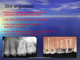 bracket positioning in orthodontics / dental crown & bridge courses | PPT