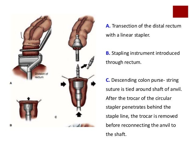 Carcinoma rectum - journal club