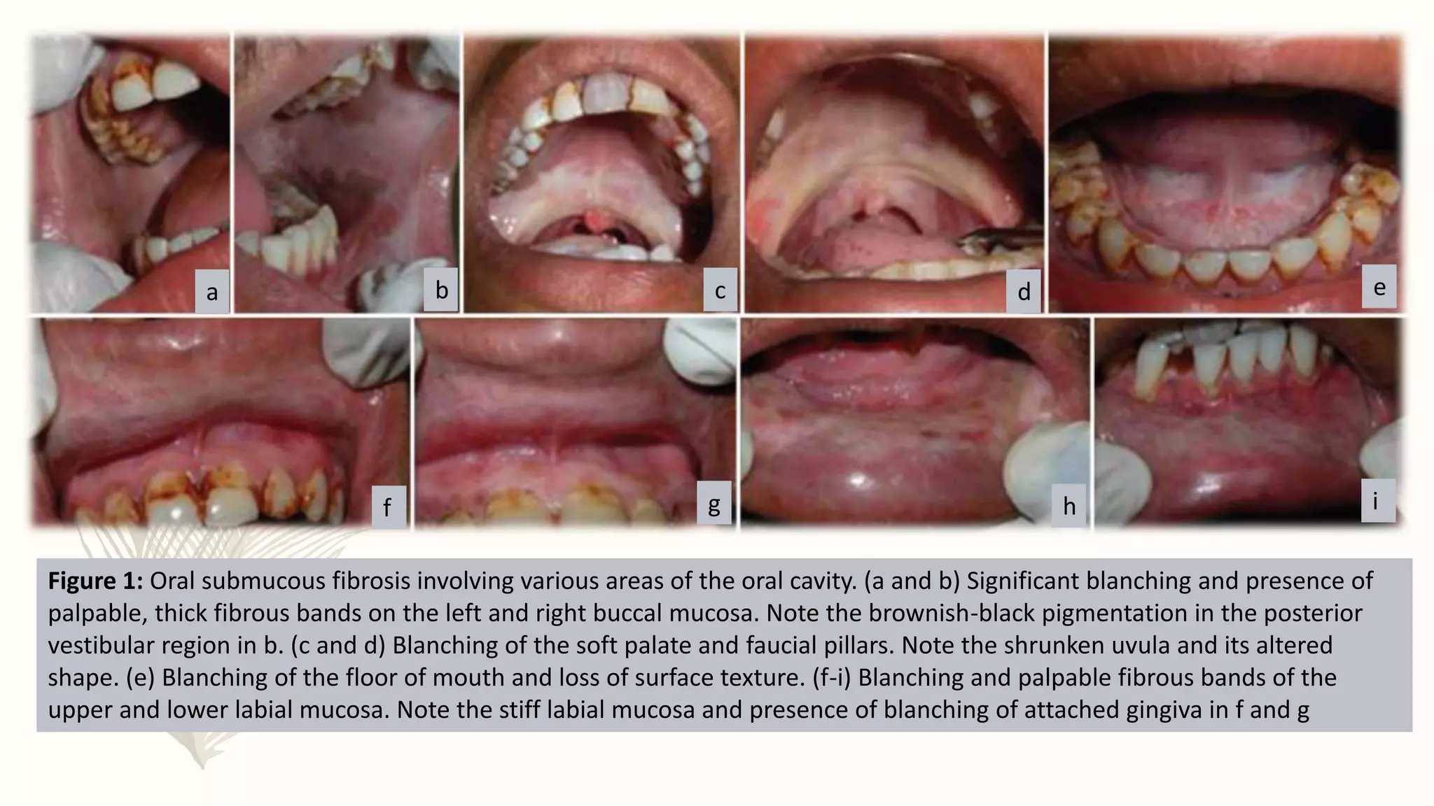 OSMF treatment of various stages- Journal Club | PPTX