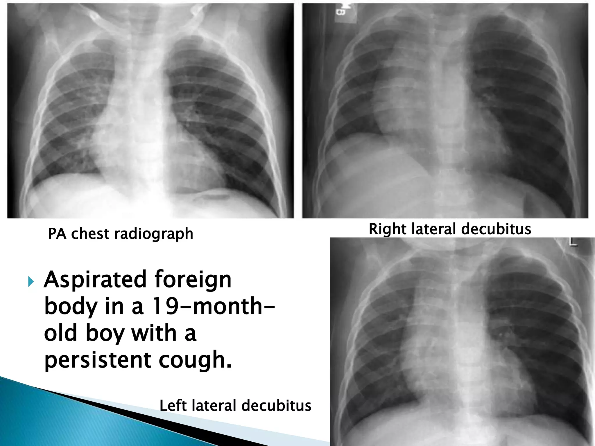 unilateral hyperlucent lung in children | PPT
