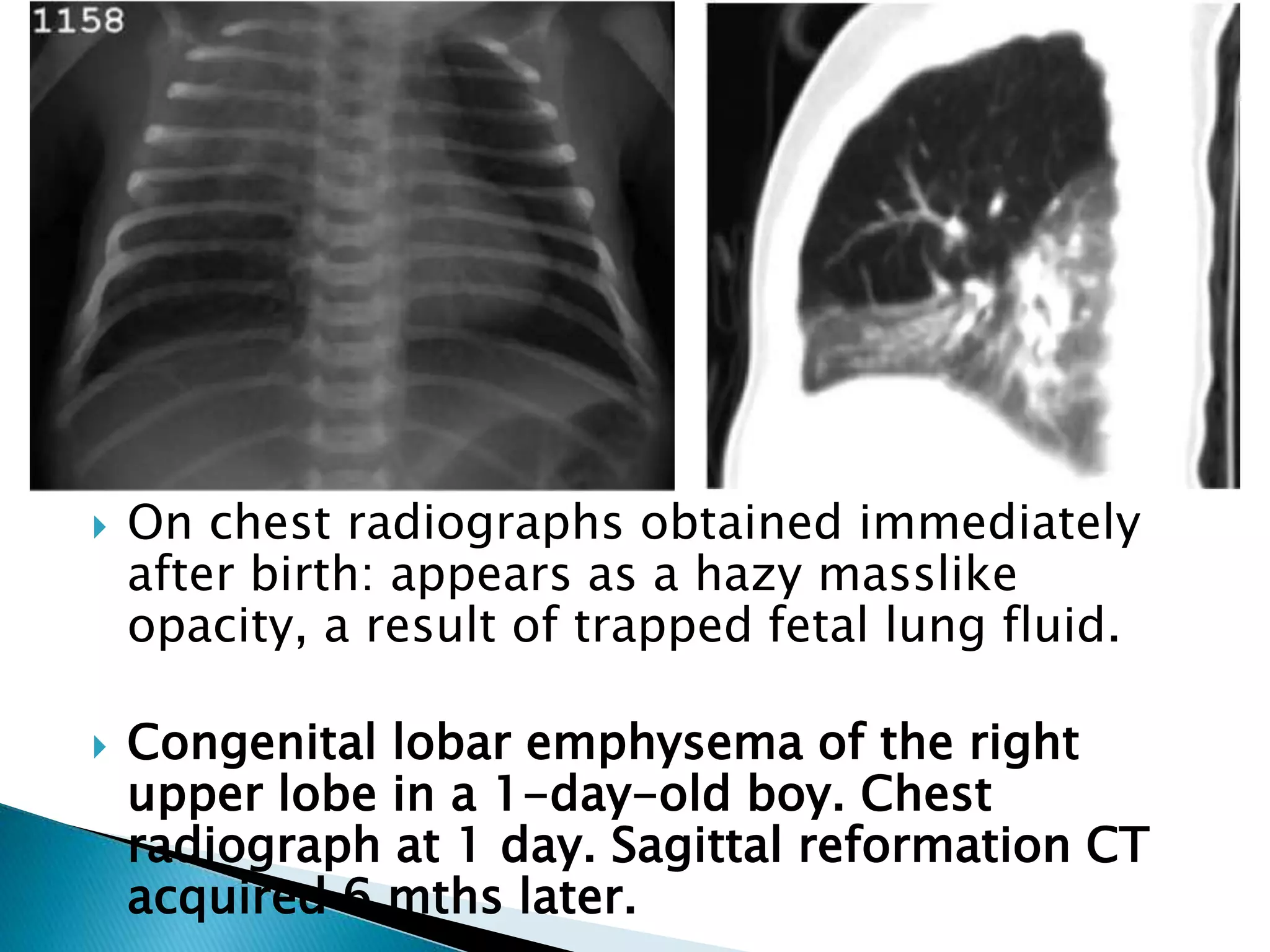 unilateral hyperlucent lung in children | PPTX