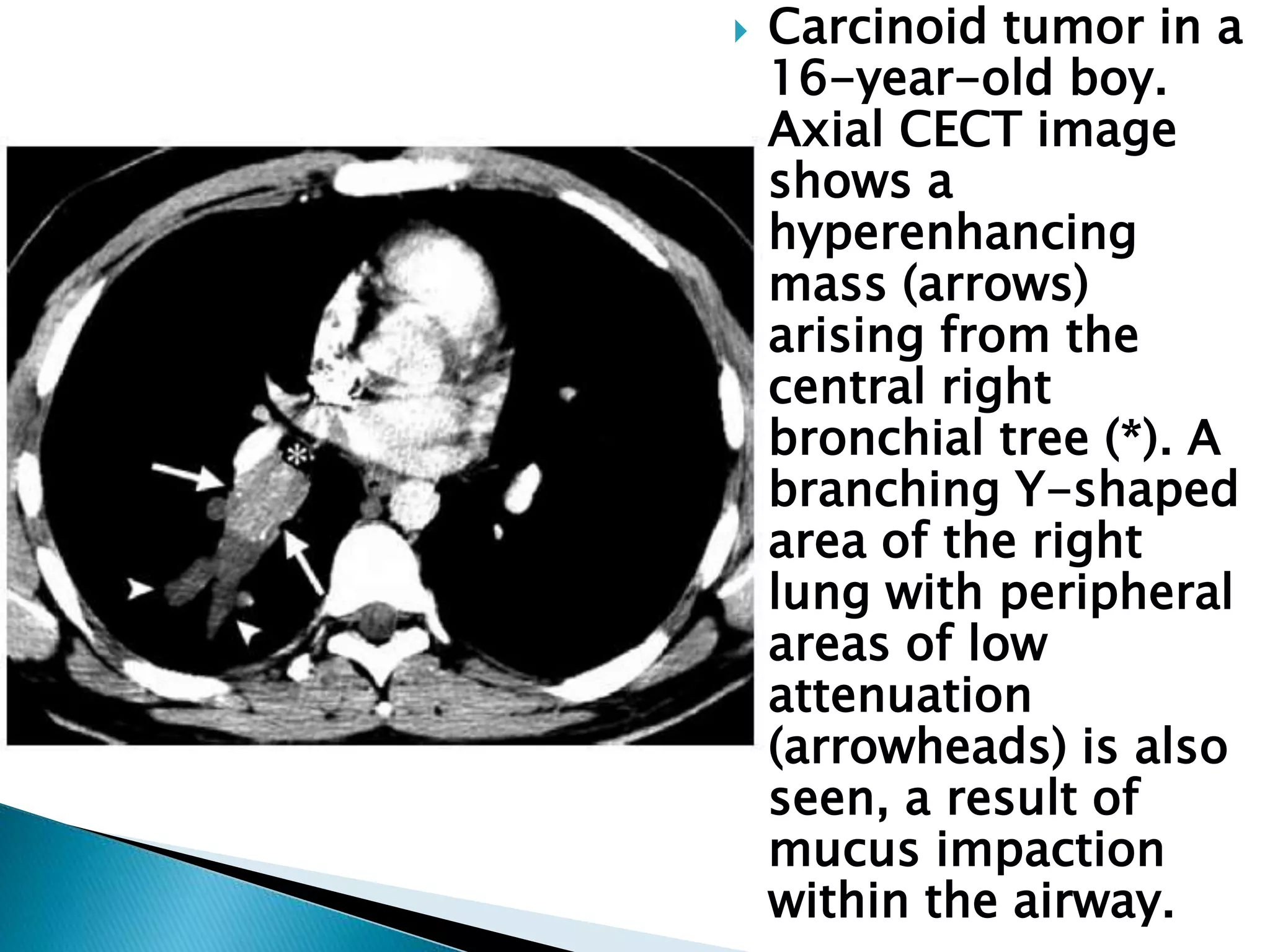 unilateral hyperlucent lung in children | PPTX