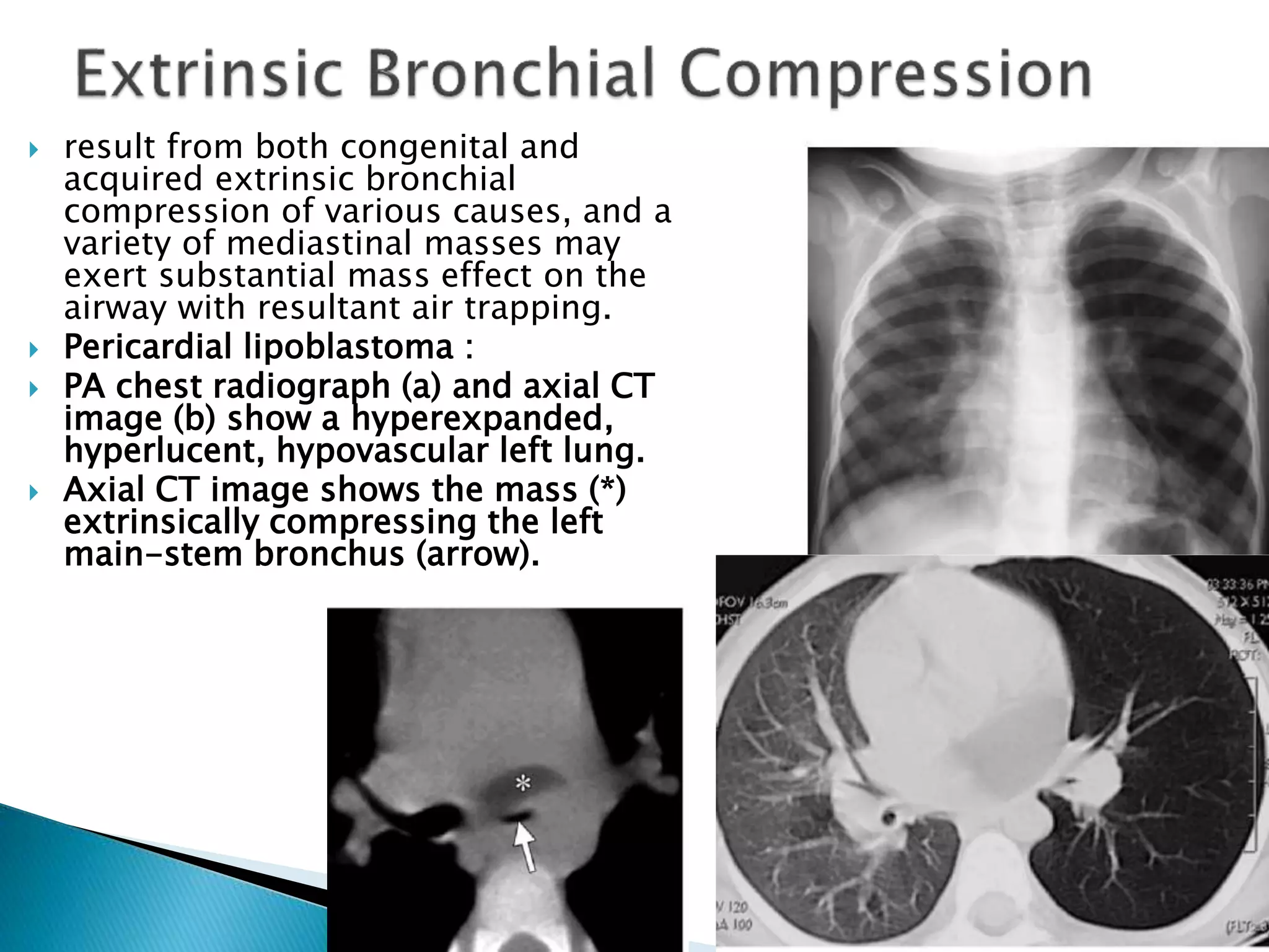 unilateral hyperlucent lung in children | PPTX