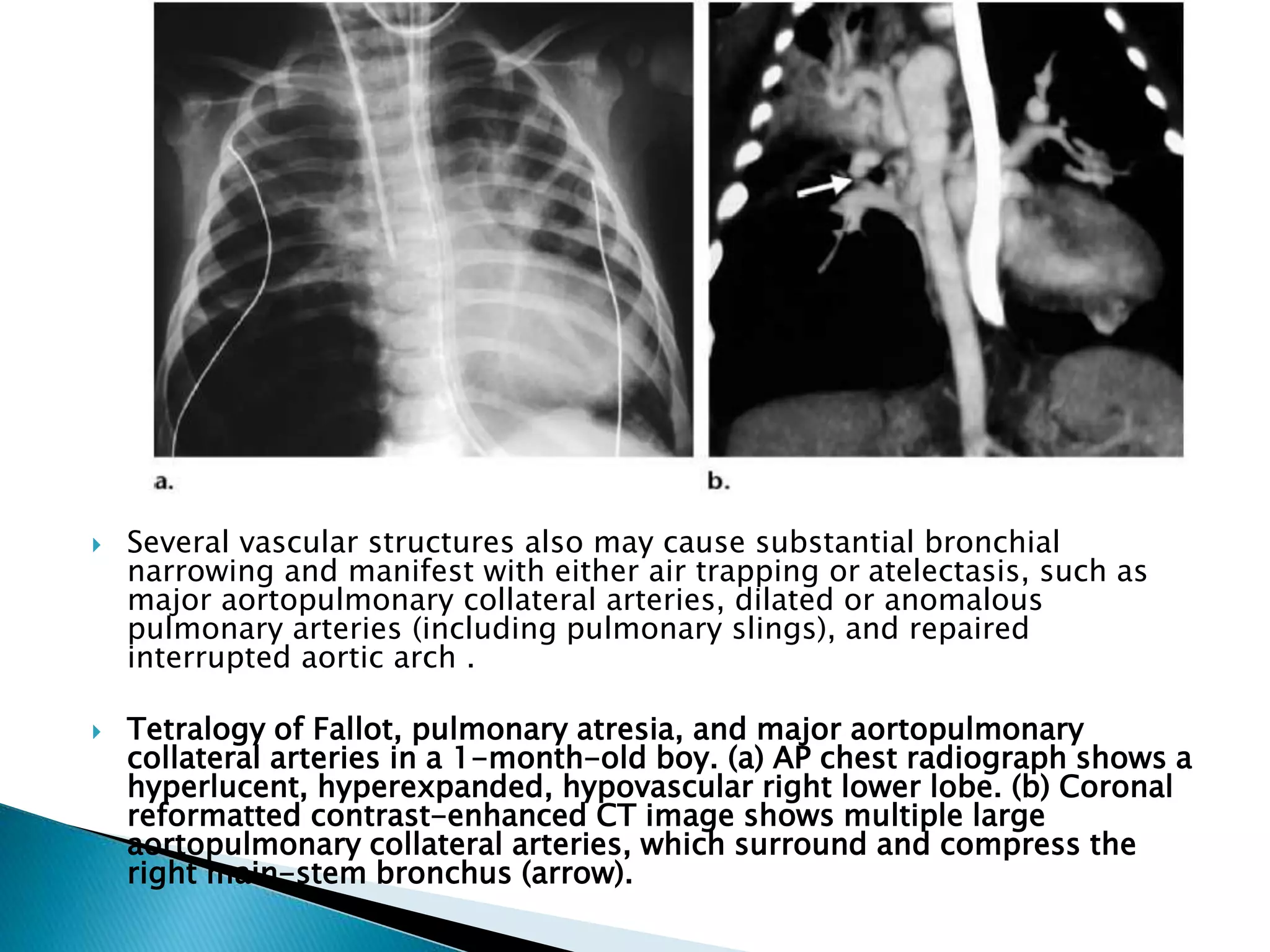 unilateral hyperlucent lung in children | PPTX