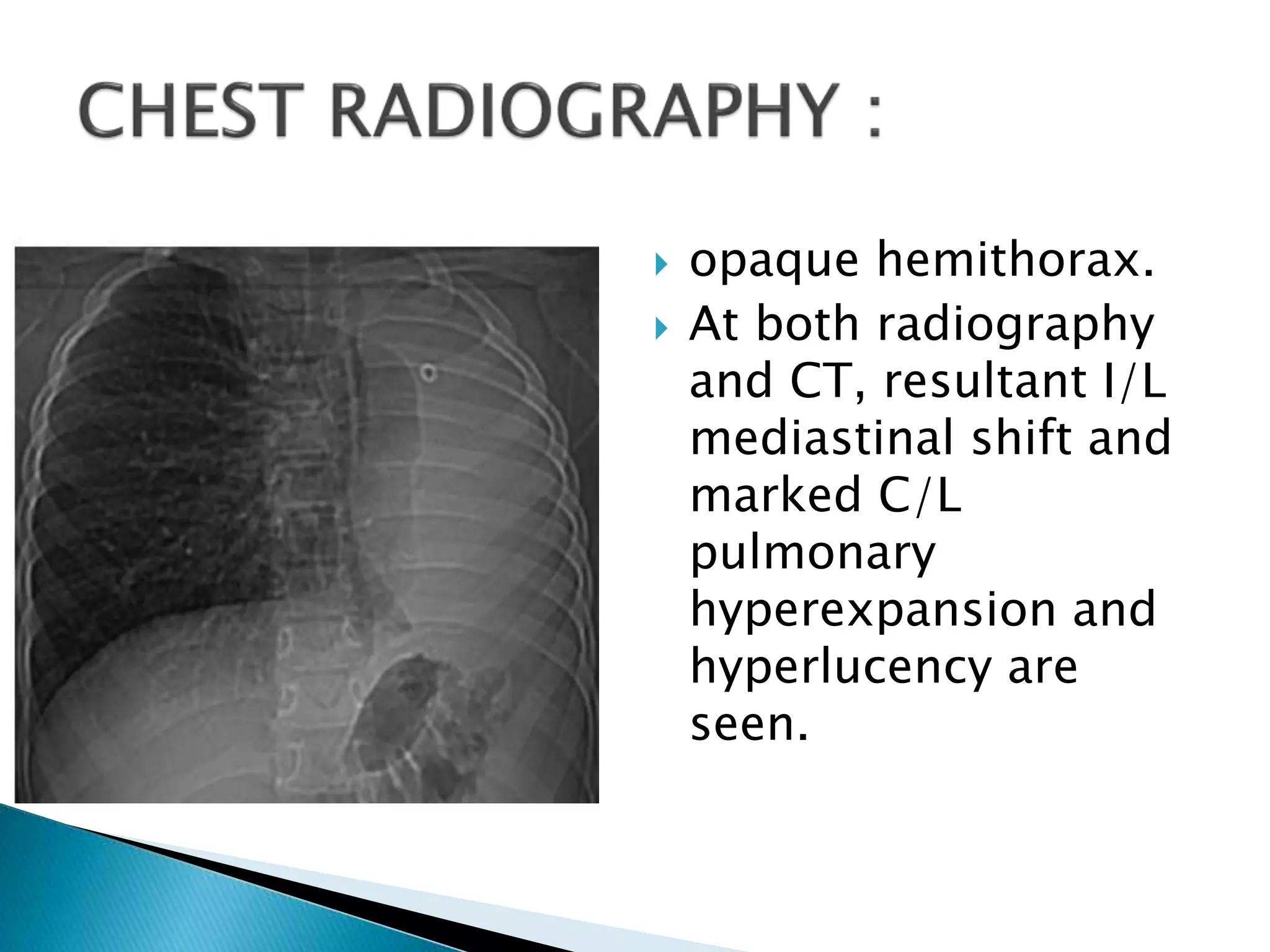 unilateral hyperlucent lung in children | PPTX
