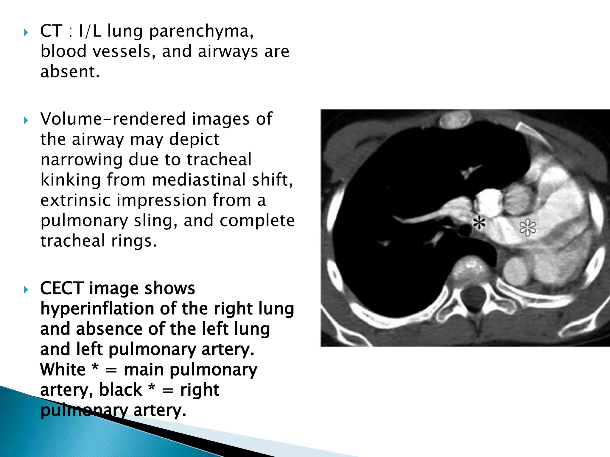 unilateral hyperlucent lung in children | PPTX