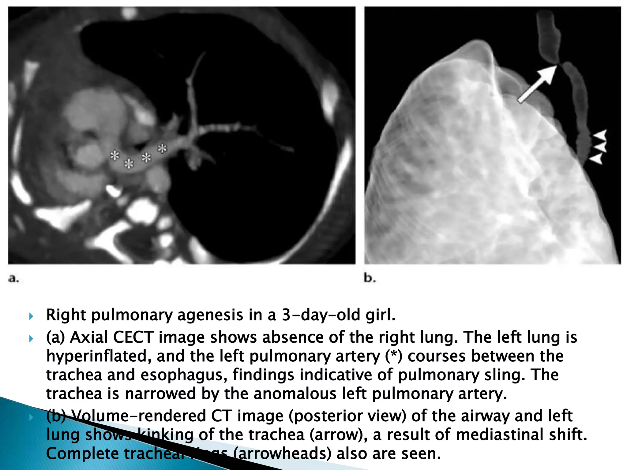 unilateral hyperlucent lung in children | PPTX