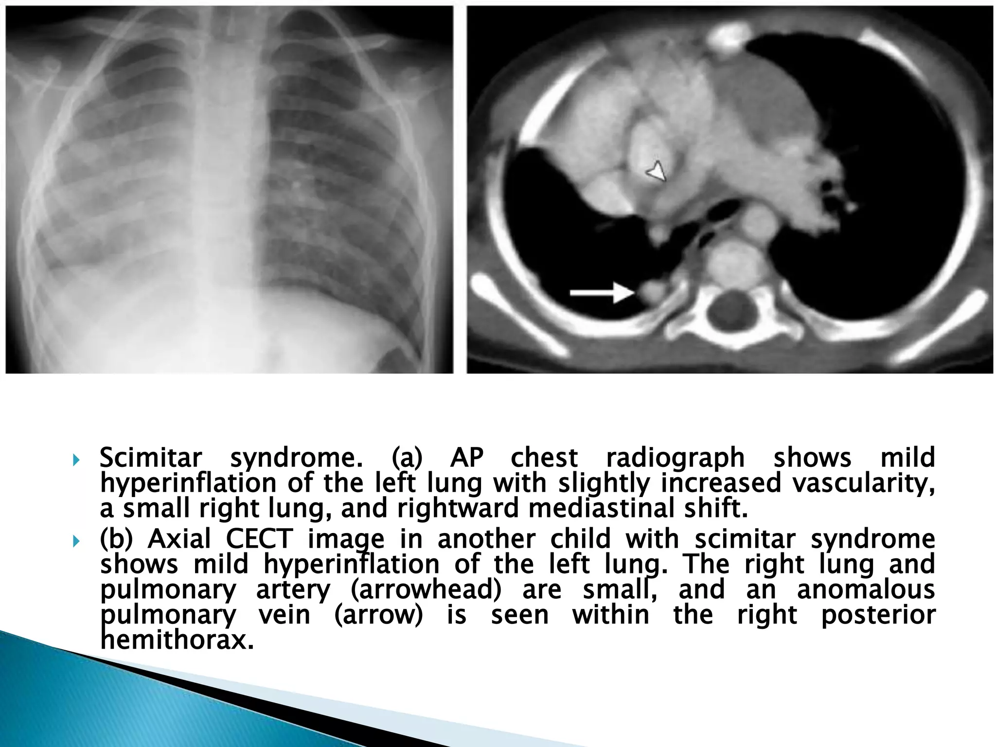 unilateral hyperlucent lung in children | PPTX