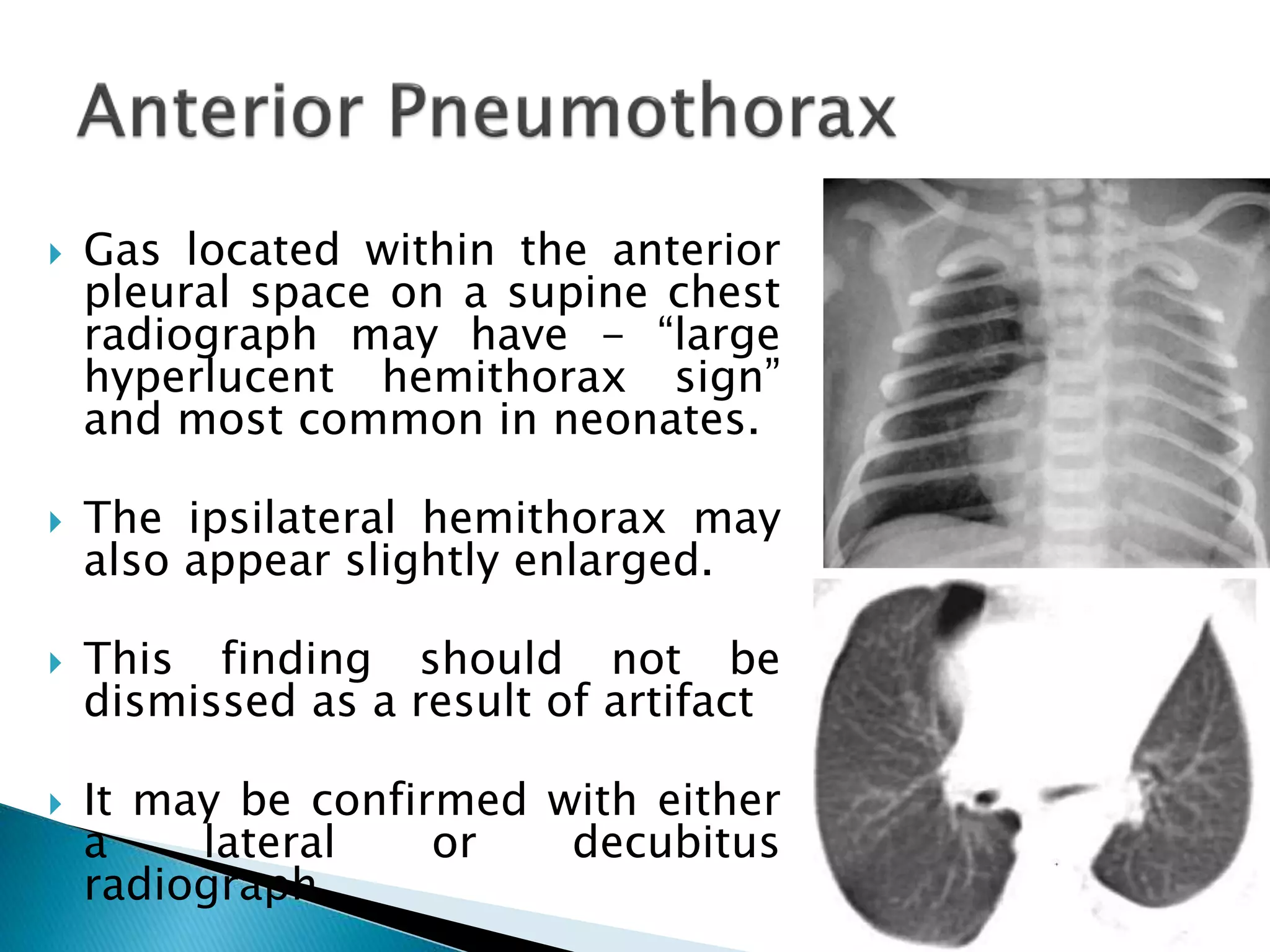 unilateral hyperlucent lung in children | PPTX