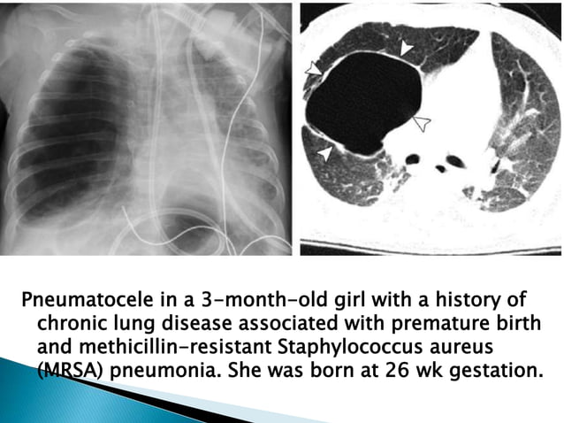 unilateral hyperlucent lung in children | PPTX