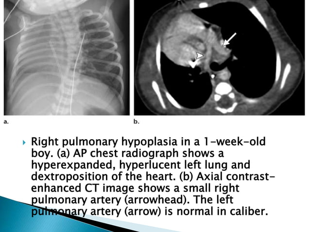 unilateral hyperlucent lung in children | PPTX