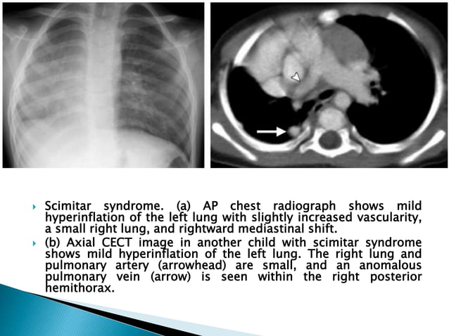 unilateral hyperlucent lung in children | PPTX
