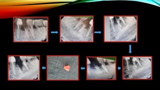 HEMISECTION INMOLAR TOOTH AND PREMOLAR TOOTH | PPTX