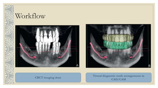 Digital workflow in full mouth rehabilitation using CBCT | PPTX