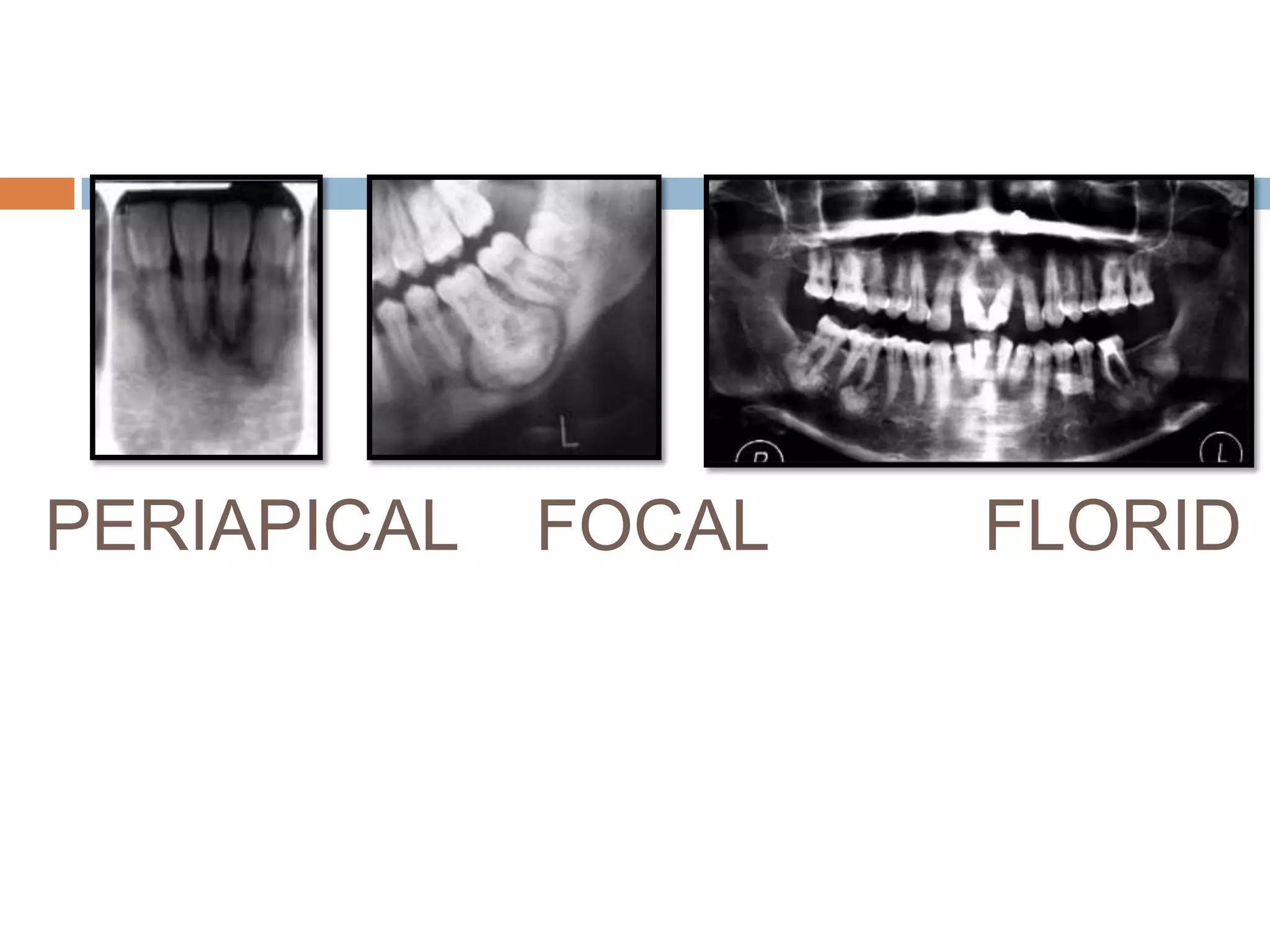 Jc 1 cbct findings of periapical cemento-osseous dysplasia-dr ...
