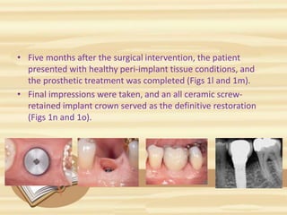Journal Club On Pre-extractive Interradicular Implant Bed Preparation ...