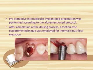 Journal Club On Pre-extractive Interradicular Implant Bed Preparation ...